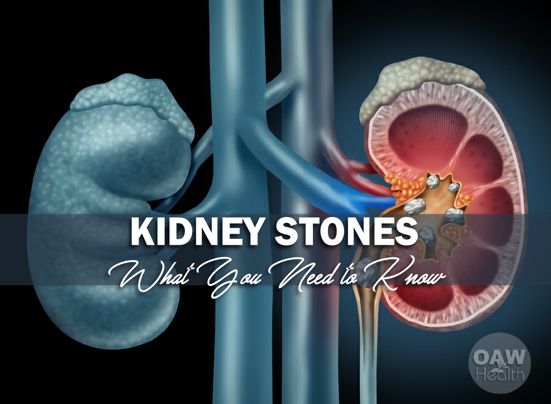 Kidney Stones - What You Need to Know - OAWHealth